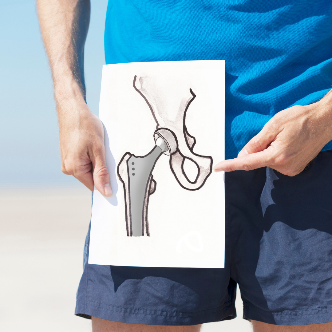Understanding Hip Replacements: Causes, Post-Operation Considerations ...