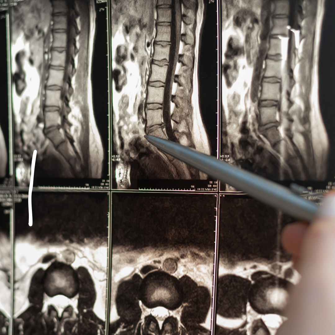 Understanding Spinal Stenosis: Causes, Symptoms, Treatment, and the ...