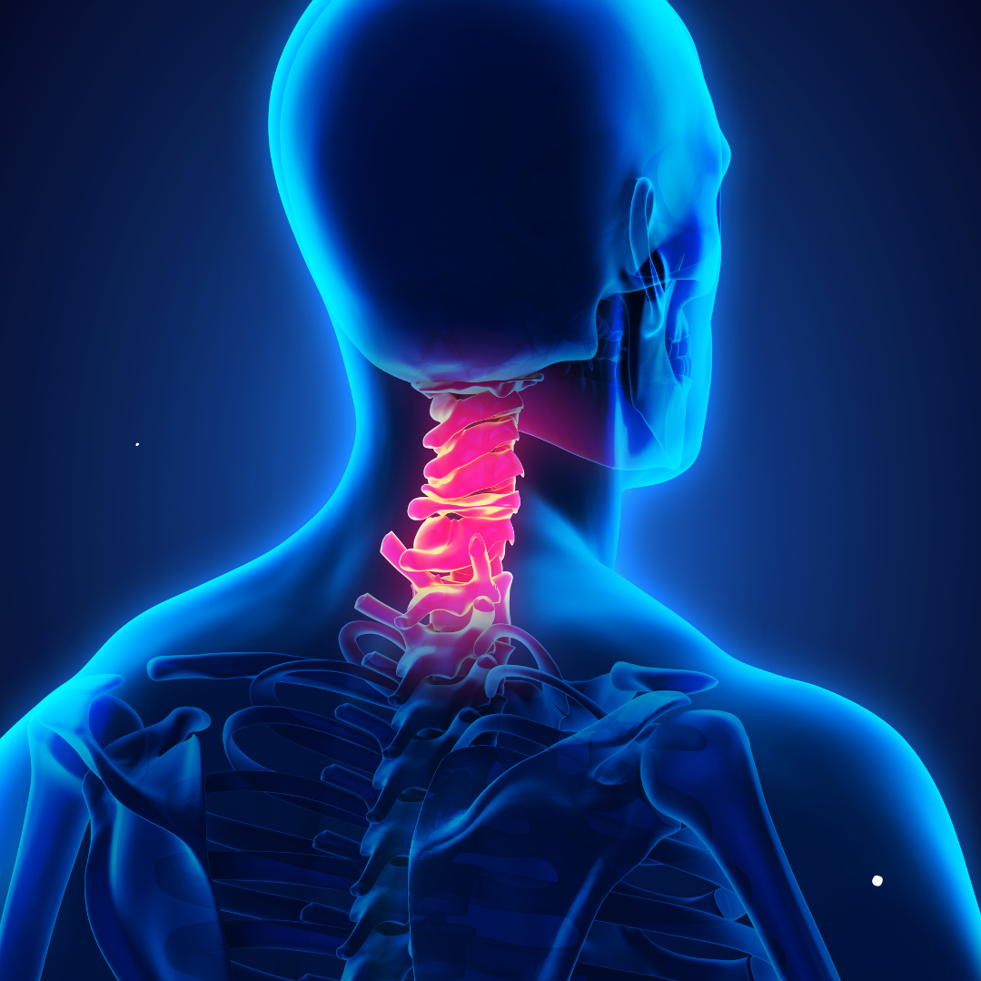 Understanding Cervical Radiculopathy: Symptoms and Osteopathic ...
