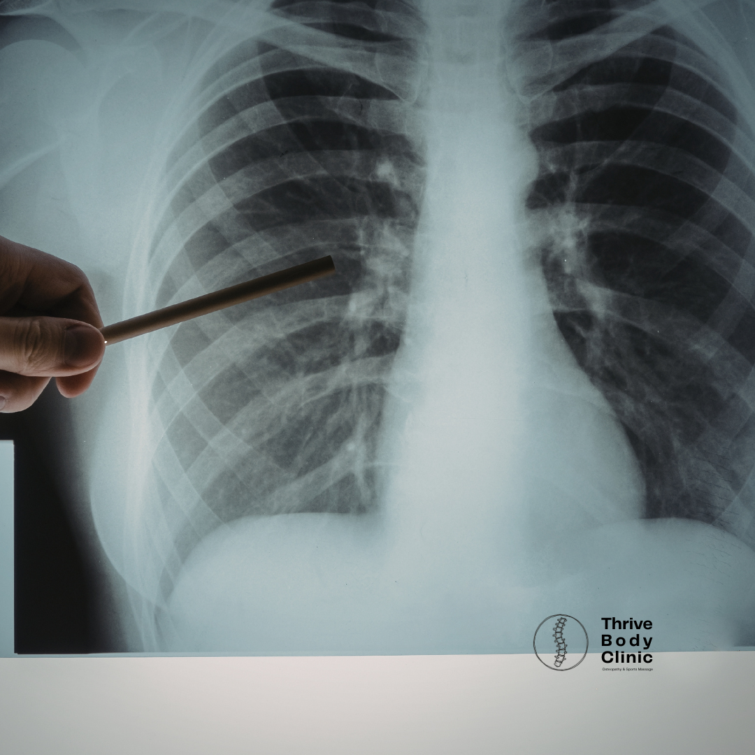 Intercostal strain — how you “tweak” it, why it’s so bloody ...